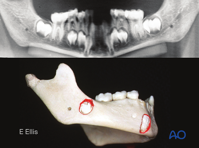 Osteosynthesis in the growing skeleton
