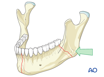 Examination of patients with mandibular fractures
