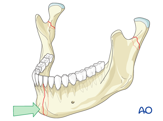 Examination of patients with mandibular fractures