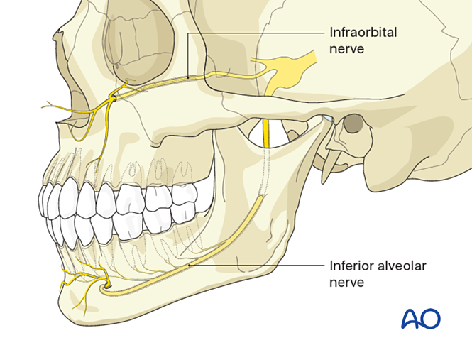 90 X12 bone supported maxillomandibular fixation NEW