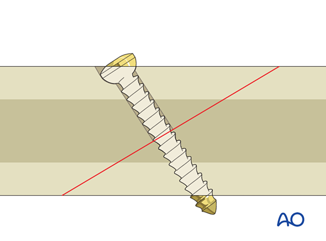 Lag screw technique