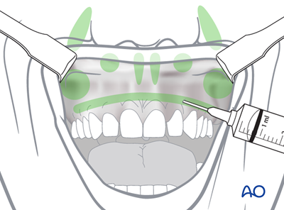 Buccal sulcus approach