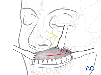 Buccal sulcus approach