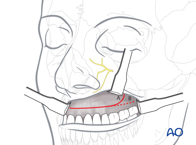 Buccal sulcus approach