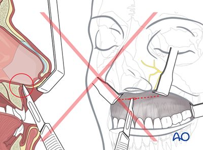 Buccal sulcus approach