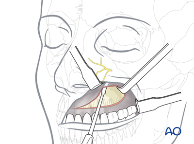 Buccal sulcus approach