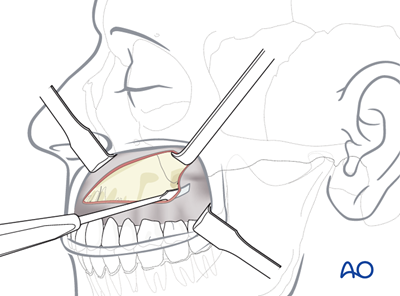 Buccal sulcus approach