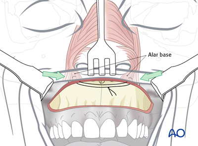 Buccal sulcus approach