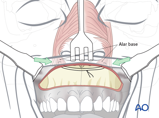 Le Fort I osteotomy for Maxillary retrognathism