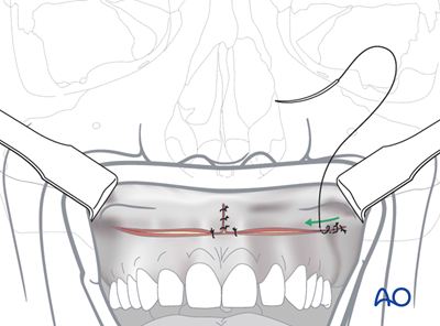 Buccal sulcus approach