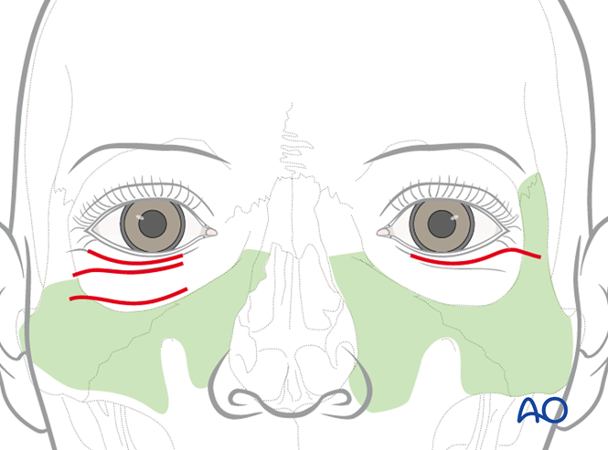 Transcutaneous lower-eyelid approaches