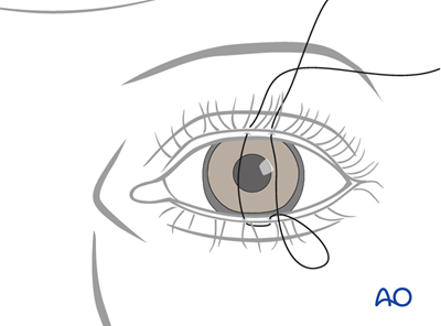 Transcutaneous lower-eyelid approaches