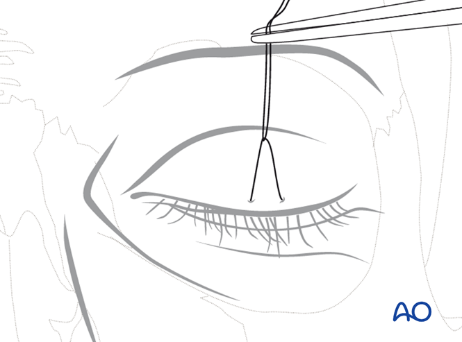 Subciliary approach