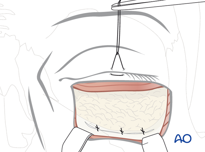 Subciliary approach