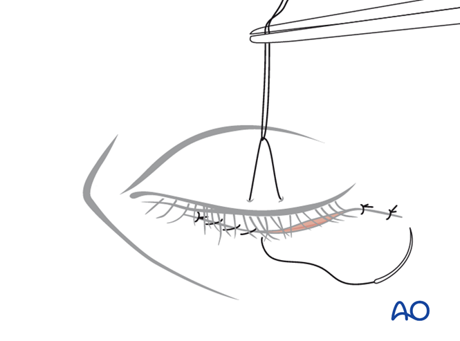 Subciliary approach