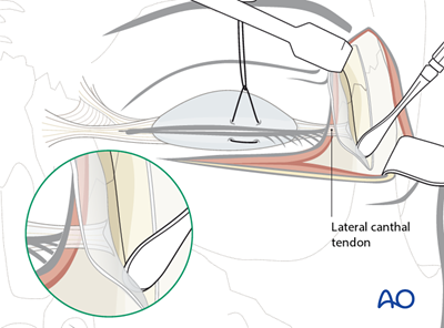 Subciliary approach