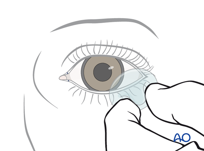 Transconjunctival approach with lateral skin extension