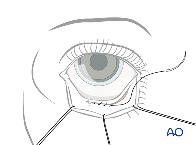 Inferior fornix transconjunctival