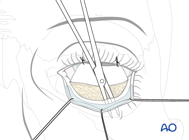 Inferior fornix transconjunctival