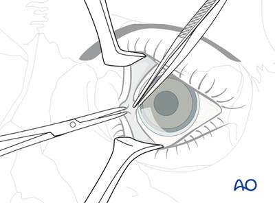 Pre-/Transcaruncular approach