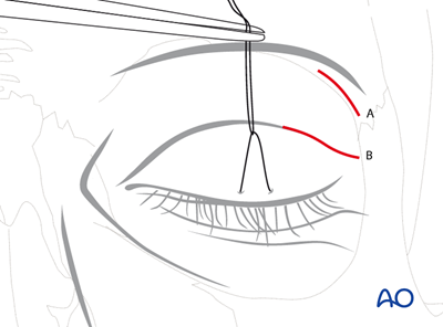 Approaches to the superolateral orbital rim
