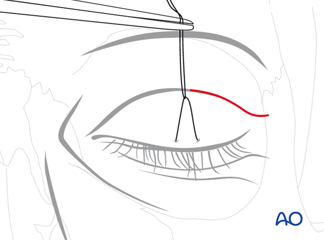 Upper-eyelid approach