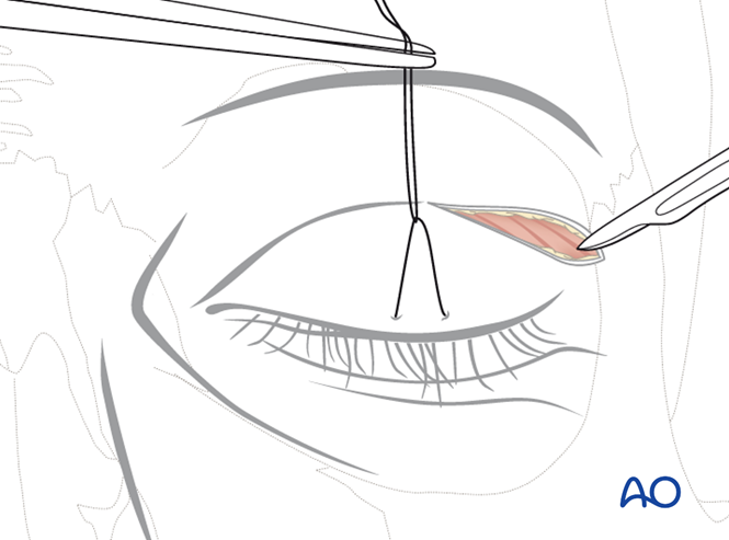Upper-eyelid approach