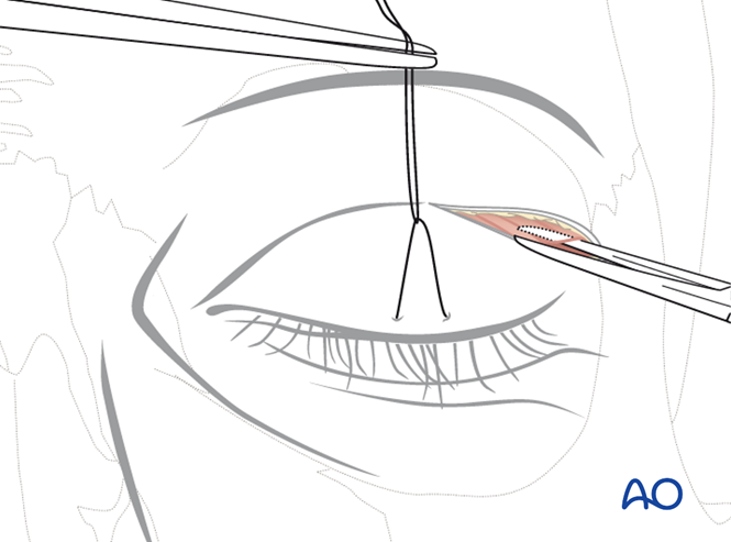 Upper-eyelid approach