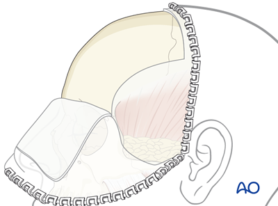 Coronal approach (including craniotomy)