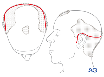 Coronal approach (including craniotomy)