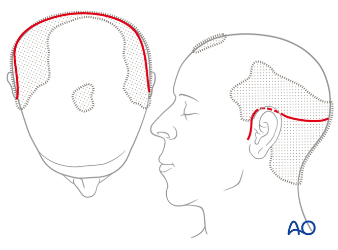 Coronal approach (including craniotomy)