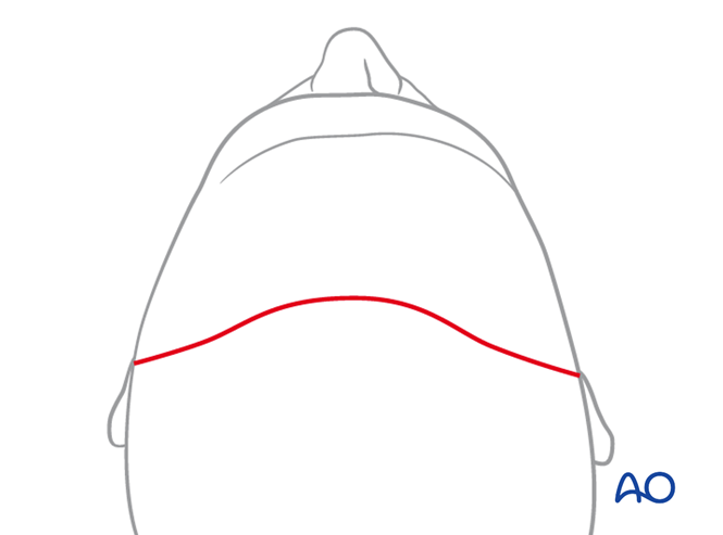 Coronal approach (including craniotomy)