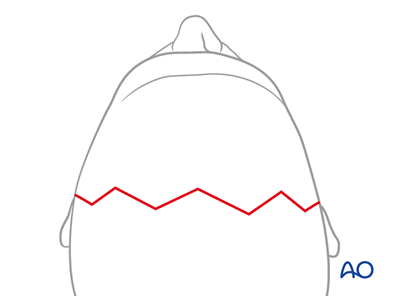 Coronal approach (including craniotomy)