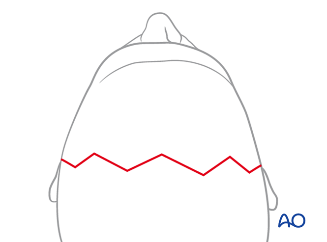 Coronal approach (including craniotomy)