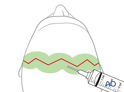 Coronal approach (including craniotomy)