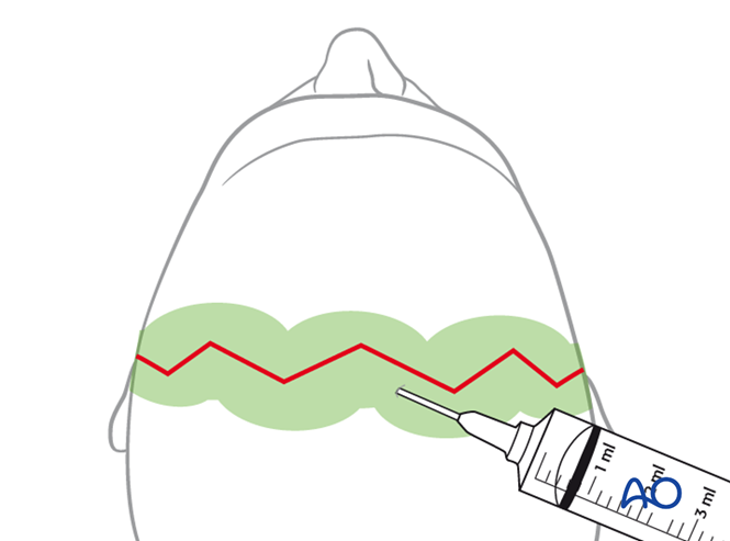 Coronal approach (including craniotomy)