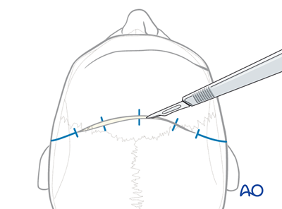 Coronal approach (including craniotomy)