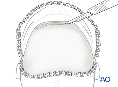 Coronal approach (including craniotomy)