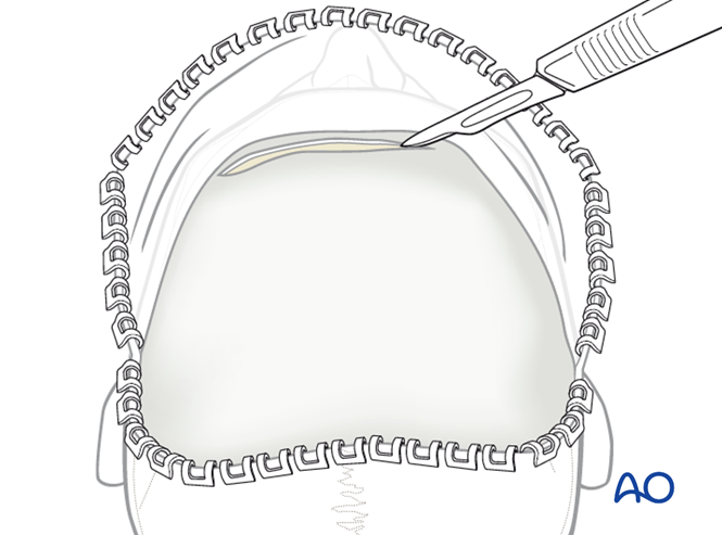 Coronal approach (including craniotomy)