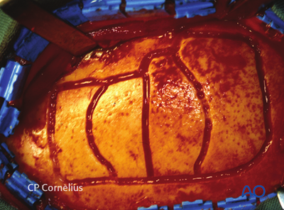 Harvesting of calvarial bone graft
