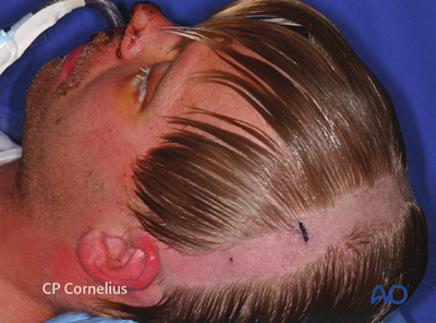 Coronal approach (including craniotomy)