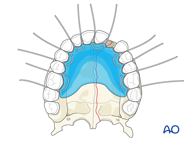 Panfacial fractures (sequencing of repair)