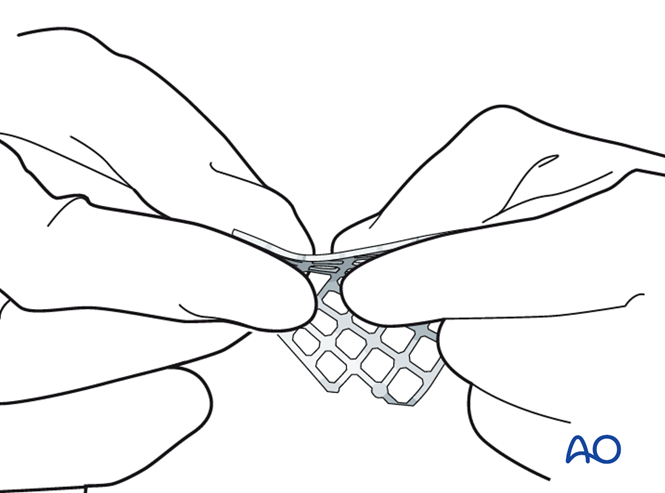 Orbitotomy with orbital roof repositioning for Supraorbital ridge ...