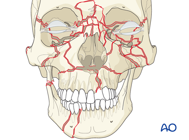 Panfacial fractures (sequencing of repair)