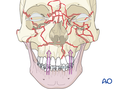 Panfacial fractures (sequencing of repair)