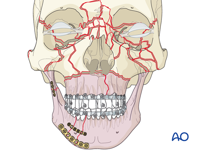 Panfacial fractures (sequencing of repair)