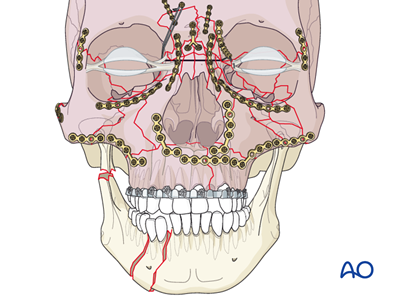 Panfacial fractures (sequencing of repair)