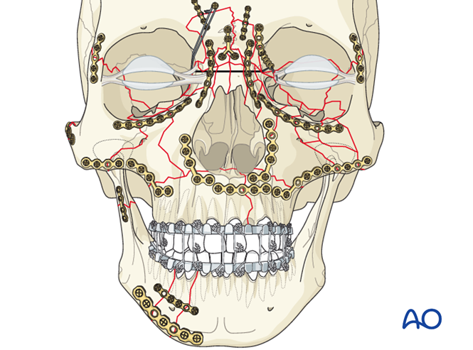 Panfacial fractures (sequencing of repair)