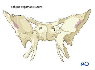 Periorbital Dissection of Lateral Orbital Wall