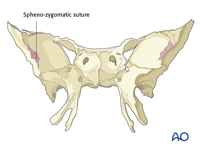 Periorbital Dissection of Lateral Orbital Wall